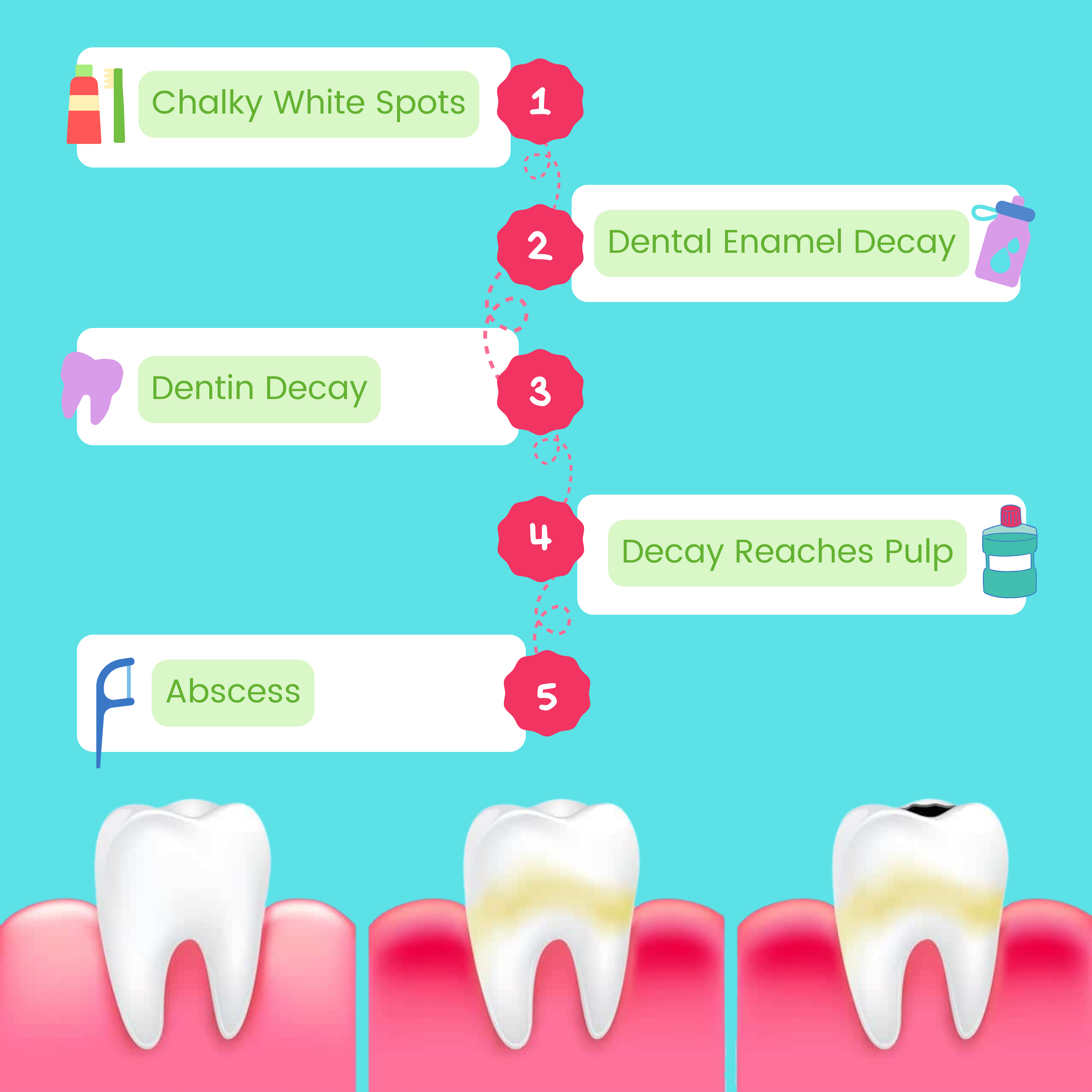 The Stages of Tooth Decay - Columbia Family Dental